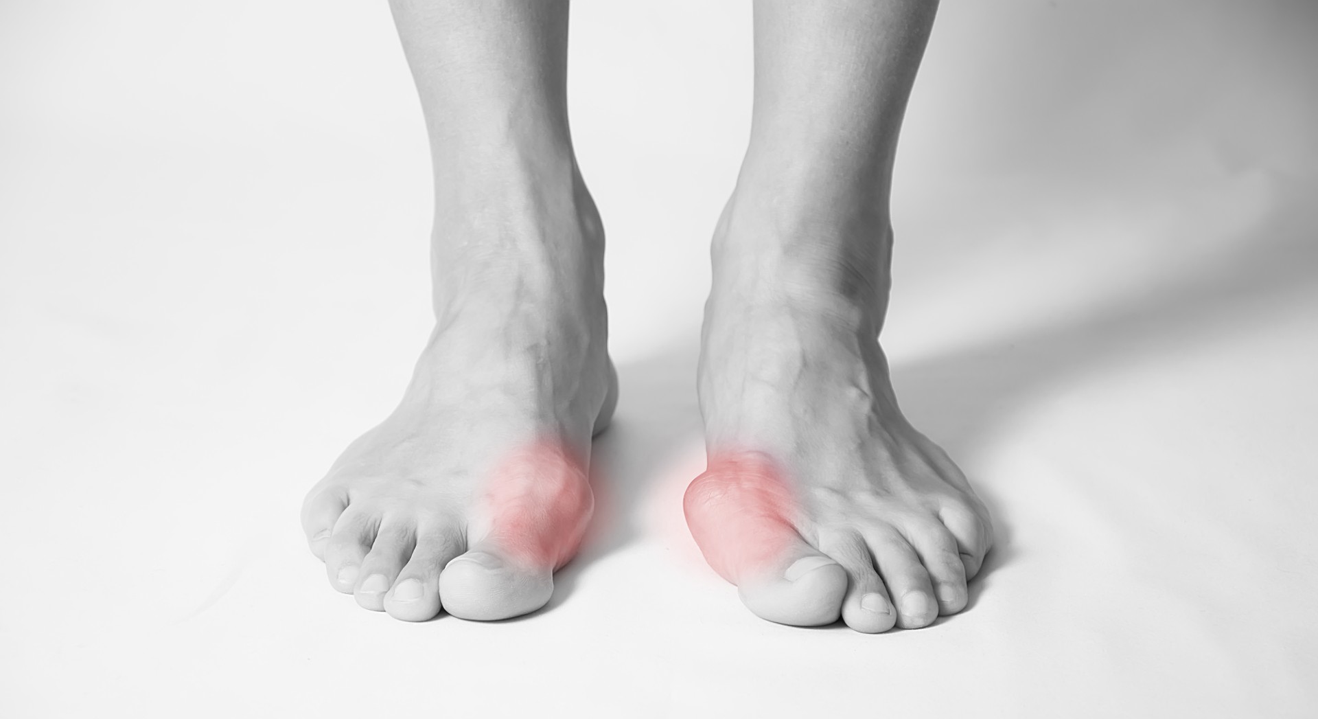7 Simple Treatments for Bunions - Northeast Foot and Ankle