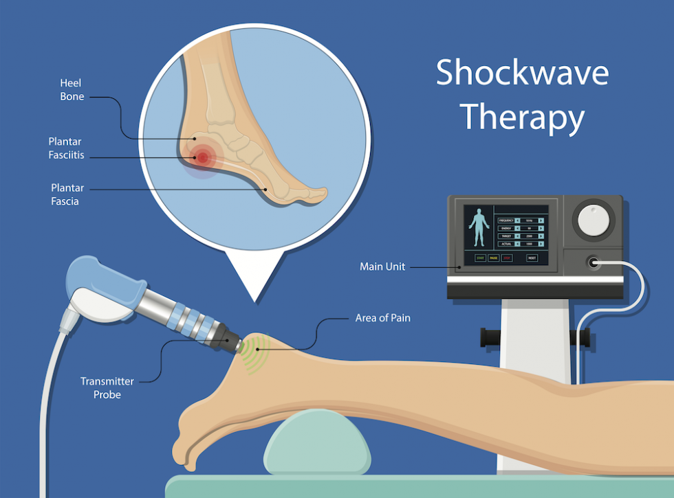 What are the benefits of EPAT (shockwave therapy)?